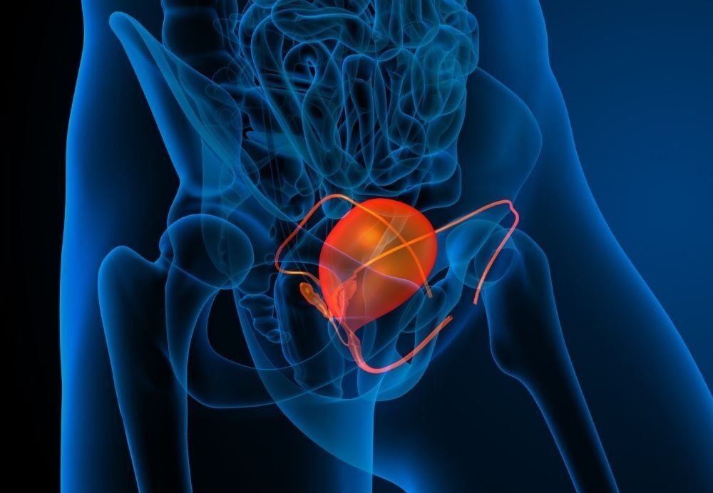 Transurethral Resection Bladder Tumour (TURBT) | Matilda International ...